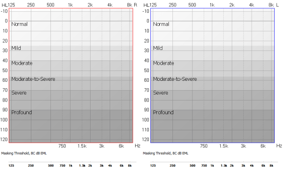 Beyond the Circles and Crosses: Understanding Your Audiogram – Sudden ...